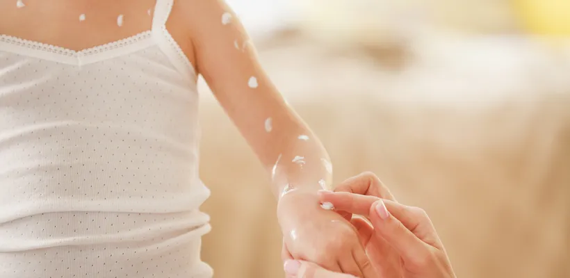 Poxclin - Chicken Pox Treatment | Weldricks Pharmacy