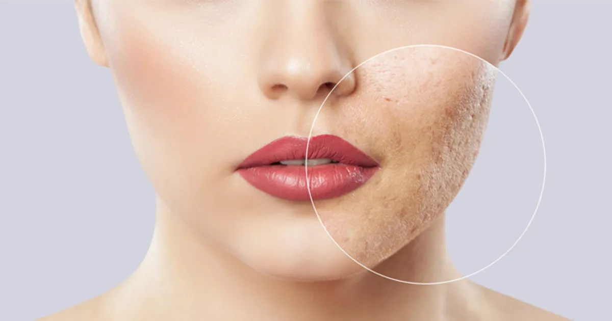 Acnecide Gel: How to Take Control of Stubborn Acne